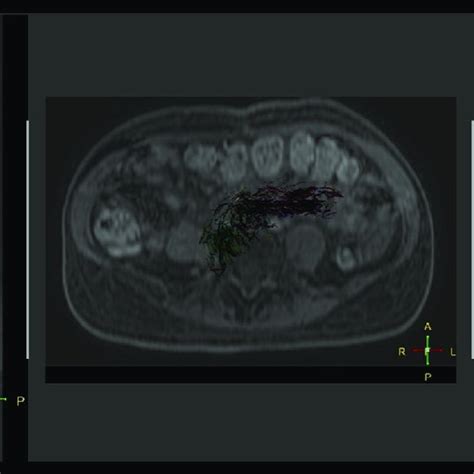 Diffusion Tensor Imaging Dti Reconstruction Of Transplanted Pancreas