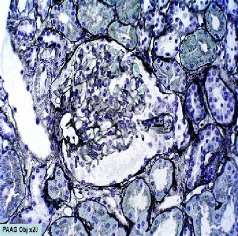 Silver Stain Showing Tip Variant Fsgs Fsgs Focal Segmental
