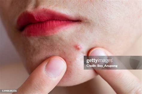 Popping Pimples On Back