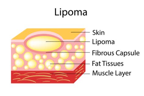 Lipoma Typescausesrisks Treatment Procedure And Recovery Factdr