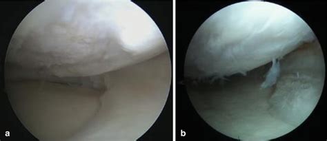 Chondral Pathology Musculoskeletal Key