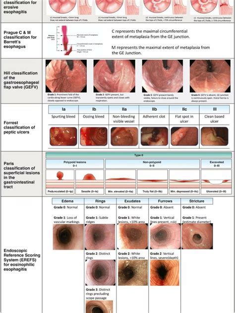 Classification Systems For Gi Endoscopy Klaus Mönkemüller