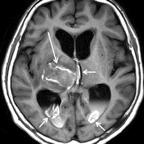 Replaced Posterior Cerebral Artery Pca Origin Of All Branches Of The Pca From The Anterior