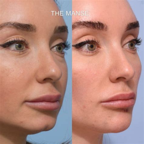 Non Surgical Facelift Best Cosmetic Clinic Sydney Advanced Practitioners