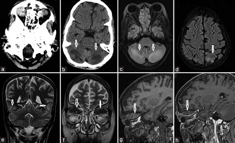 Rapidly Resolving Orbital Pseudotumor In Systemic Lupus Eryt Indian Journal Of Rheumatology
