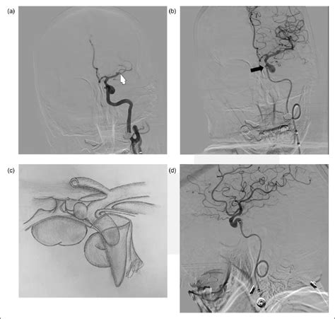 A Angiography Dsa Demonstrates The Point Of Obstruction White Download Scientific Diagram
