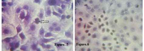The Cells Of Hep 2 Cell Line Shows Condensed Nuclear Chromatin
