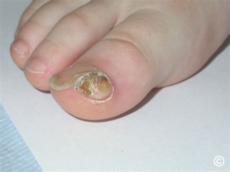 Exostosis Of Foot