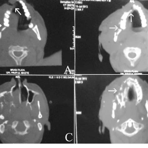 Ct Scan Pictures Depicting The Mandibular Fractures A And B