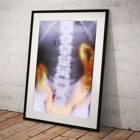 Spinal Cord Ulcerative Colitis X Ray Art Print By Science Source