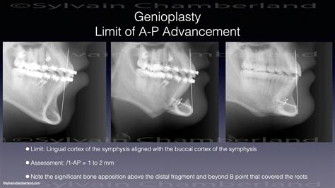 Advancement Limit For Genioplasty Dr Sylvain Chamberland Orthodontist