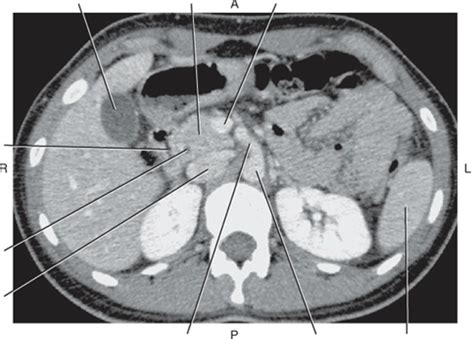 Ct Thru Common Bile Duct Diagram Quizlet