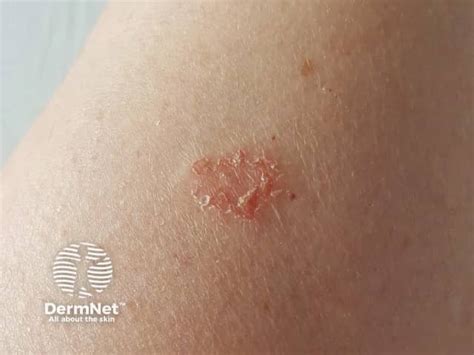 Dermnet® Discoid Eczema Day 6 Image