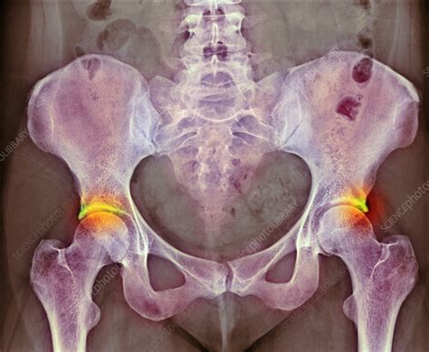 Femoroacetabular Impingement X Ray Stock Image C061 4734 Science