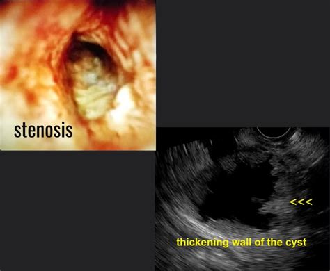 Filippo Antonini On Linkedin Ercp Eus Cholangioscopy Spyglass Moray