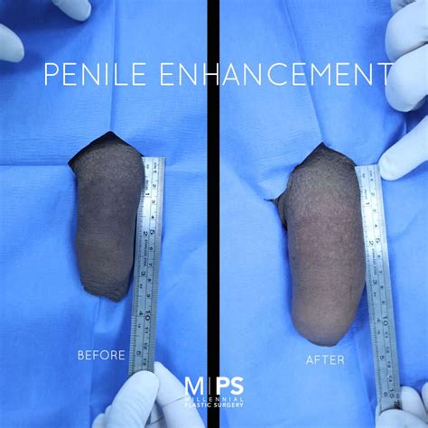 Penile Enhancement Center Of New York Male Enhancement Specialists