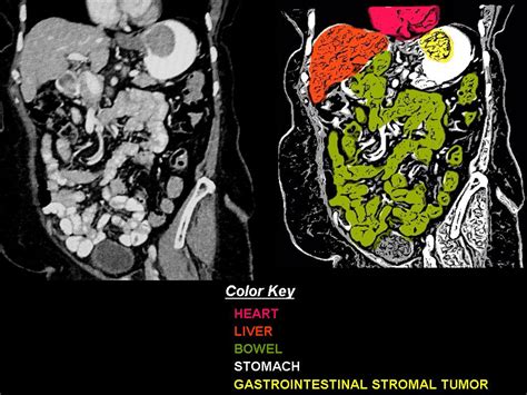 University Of Toledo Radiology Gastrointestinal Stromal Tumor