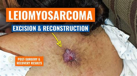 Leiomyosarcoma Of Back Excision And Reconstruction Youtube