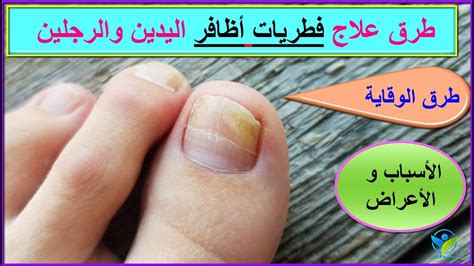 فطريات الاظافر طرق العلاج الاسباب الاعراض الموسوعة الطبية Youtube