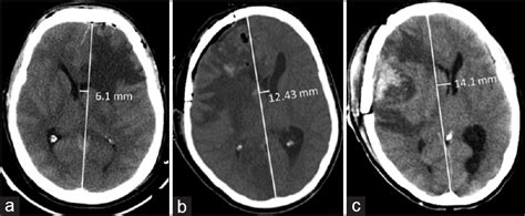 Surgical Neurology International