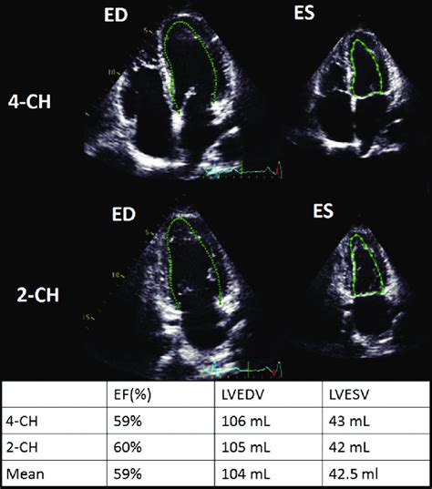 Automated Assessment Of Left Ventricle Ejection Fraction And Volumes