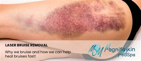 Bruising Magnifaskin Medspa Medical Spa In Wilmington De
