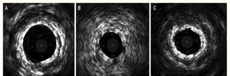A C Post Interventional Cross Sectional Intravascular Ultrasonography Download Scientific