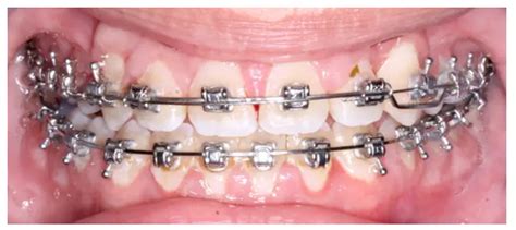 Gingivitis Y Ortodoncia Cómo Prevenir Y Tratar La Inflamación De Las