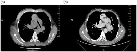 Lung Computed Tomography Ct Images A Lung Ct Image Showing An Download Scientific Diagram