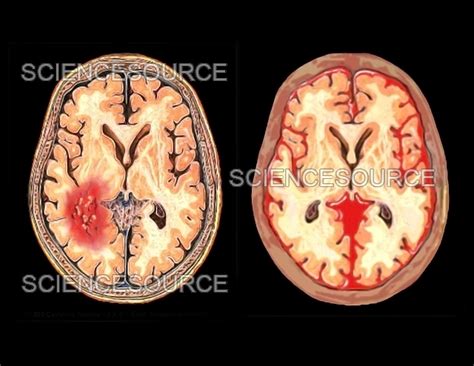Subdural Hematoma Vs Subarachnoid Hemorrhage