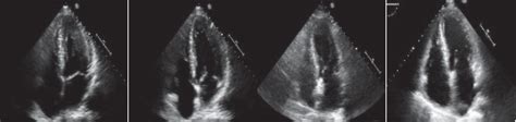 Figure From Echocardiography Segmentation Based On A Shape Guided