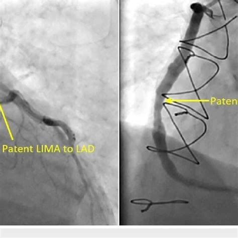 Retrograde Flow From The Lad To Lima And Back To The Left Sa Lad Left Download Scientific