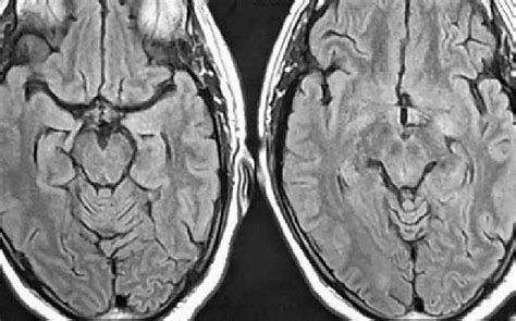 Magnetic Resonance Imaging Cranium T Revealed Resolution Of Lesion Download Scientific Diagram