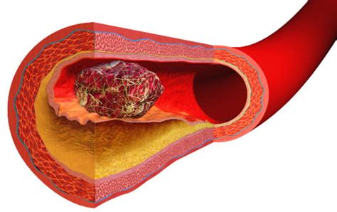 D Dimer During Pregnancy Increased Causes Of High Values After Embryo Transfer In 1 2 3