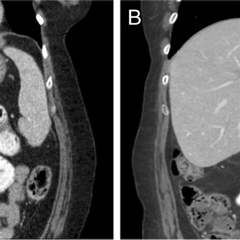 Ectopic Tumor Related Hepatic Calcification In A Patient With Download Scientific Diagram