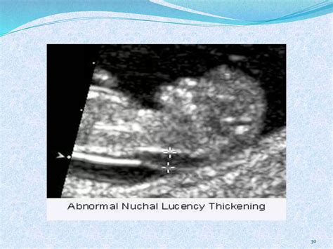 Biochemical Markers Of Prenatal Diagnosis Pptx