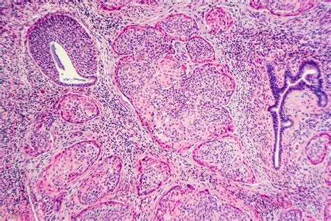 Cervical Cancer What Doctors Wish You Knew The Healthy