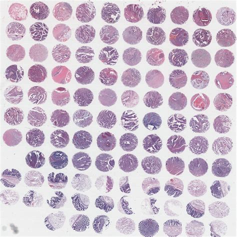 Colorectal Cancer Crc Tissue Microarray Tma A Hematoxylin And Download Scientific