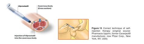 When Testosterone Doesnt Lead To Better Erections Or Sex Drive Excel Male Health Forum