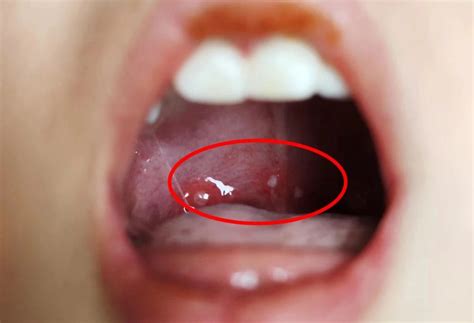 疱疹性咽峡炎感染高发，该如何应对？ 医牛健康资讯