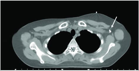 Radiation Planning Ct After Axillary Lymph Node Dissection The Arrow