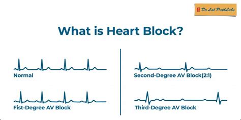 Different Types Of Heart Blocks