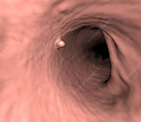 Polyps In Colon Ct Scan At Darla Adkins Blog