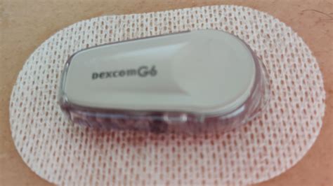 Personal Experience Of The Dexcom G6 Experience After Using It 1 Month