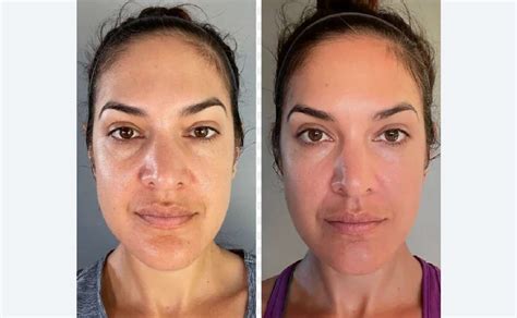 Discover The Transformation Gua Sha Before And After Gua Sha Company