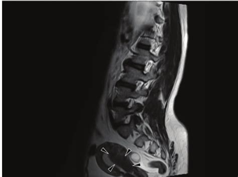 Adenomyosis 44 Years Old Female Sagittal T2 Weighted Image Arrowheads