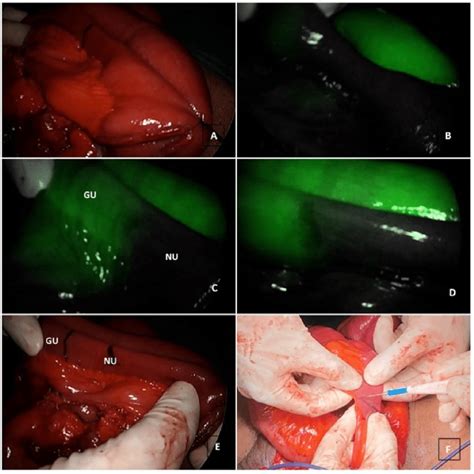 Case Of Right Complete Irreducible Inguinal Hernia With Features Of