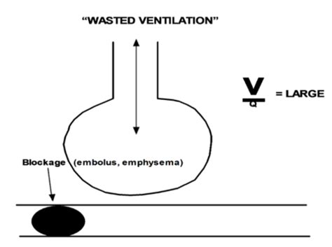 Week 10 Ventilation Perfusion Relationship Flashcards Quizlet