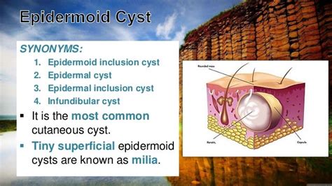 Epidermoid Cyst Diagram