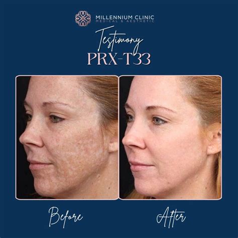Prx T33 Millennium Clinic Kl